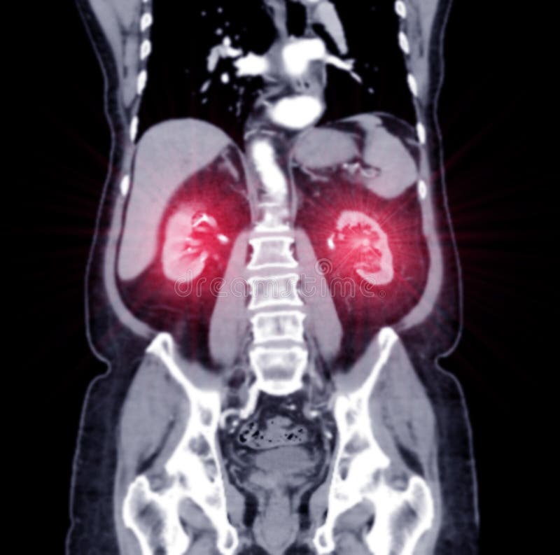 CT Scan of Whole Abdomen with Injection Contrast Media in Coronal View ...