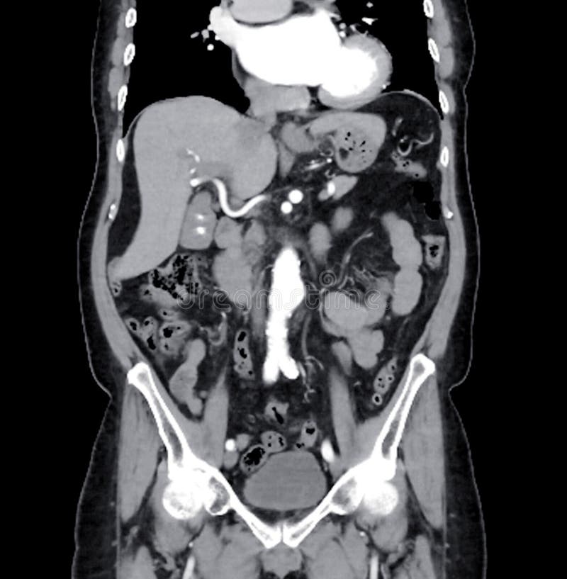 CT Scan of Whole Abdomen with Injection Contrast Media in Coronal View ...