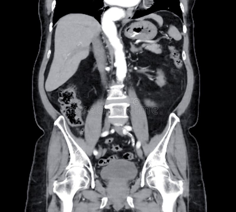 CT Scan of Whole Abdomen with Injection Contrast Media in Coronal View ...