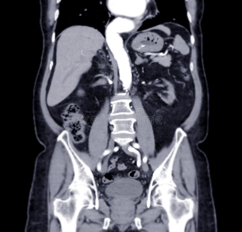 CT Scan of Whole Abdomen with Injection Contrast Media in Coronal View ...