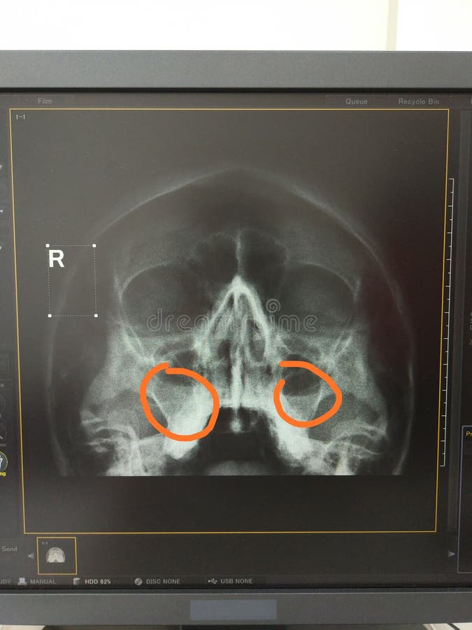 Results of CT Scans of the Head on the Screen Stock Image - Image of ...