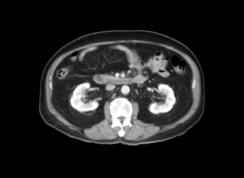 CTA of Aorta and Major Branches:.a Comprehensive CTA Scan Showing the ...