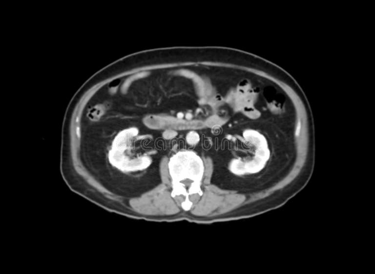 CTA of Aorta and Major Branches:.a Comprehensive CTA Scan Showing the ...
