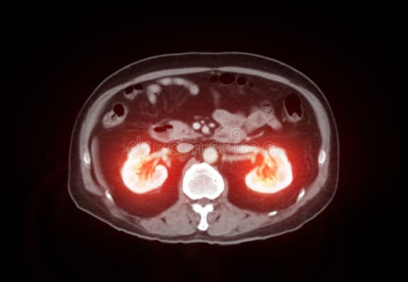 CTA of Aorta and Major Branches:.a Comprehensive CTA Scan Showing the ...