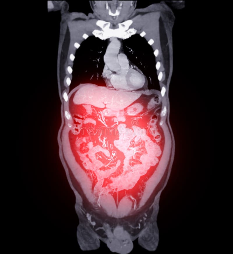 CTA of Aorta and Major Branches:.a Comprehensive CTA Scan Showing the ...