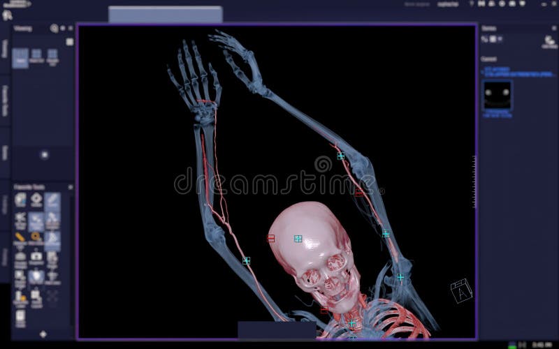 Cta Brachial Artery Or Ct Scan Of Upper Extremity 3d Rendering Image