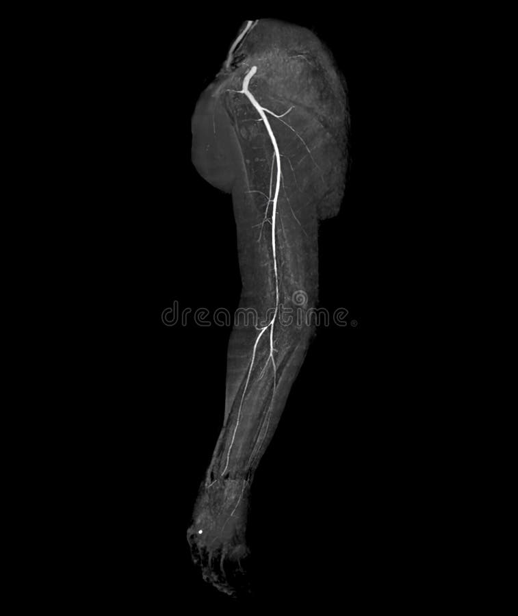 Cta Brachial Artery Or Ct Scan Of Upper Extremity 3d Rendering Image