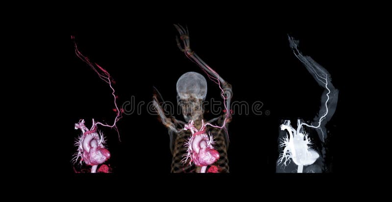 CTA Brachial Artery or CT Scan Vessel of Upper Extremity . Stock Image ...