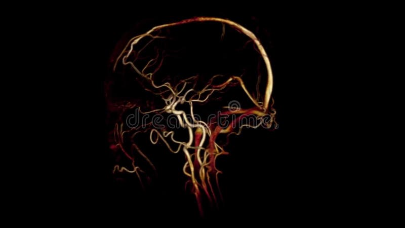 CTA Brain or Computed Tomography Angiography of the Brain 3D Rendering ...