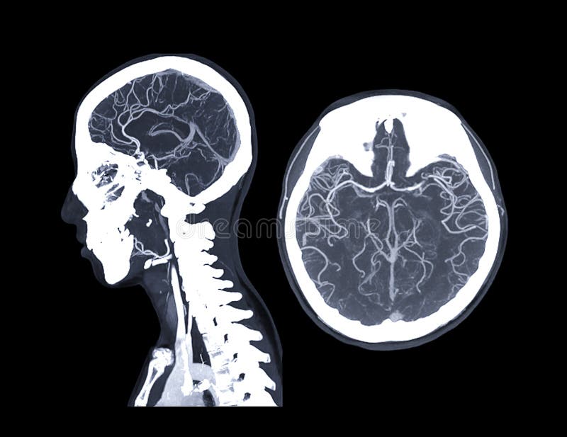 CTA Brain or CT Angiography of the Brain . Stock Image - Image of ... CTA Brain or CT Angiography of the Brain . Stock Image - Image of ...