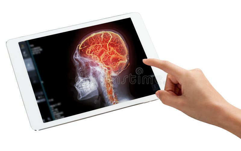 CTA Brain Imaging Shows a 3D Brain CTA Scan Displayed on a Tablet, with ...