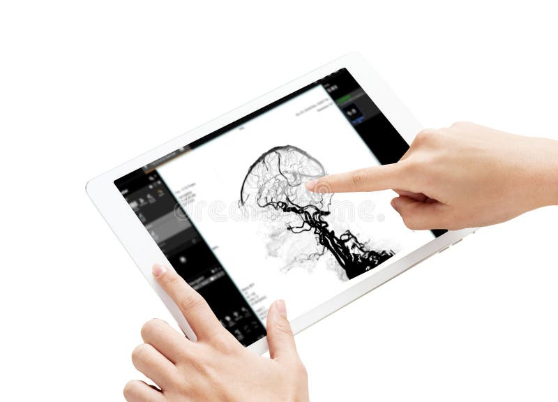 CTA Brain Imaging Shows a 3D Brain CTA Scan Displayed on a Tablet, with ...