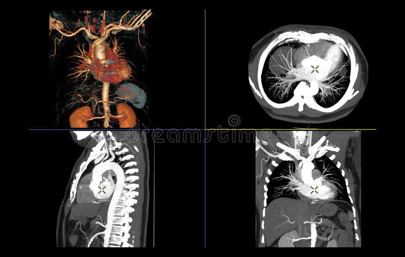 CTA Thoracic Aorta 3D Rendering Image Stock Image - Image of equipment ...