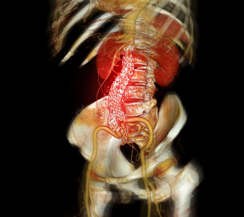 CTA Whole Aorta with Abdominal Aorta Stent Graft Compare 3D Rendering ...