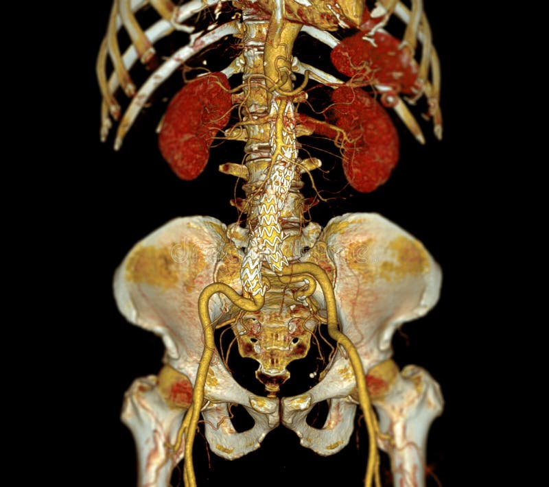 CTA Whole Aorta with Abdominal Aorta Stent Graft Compare 3D Rendering ...