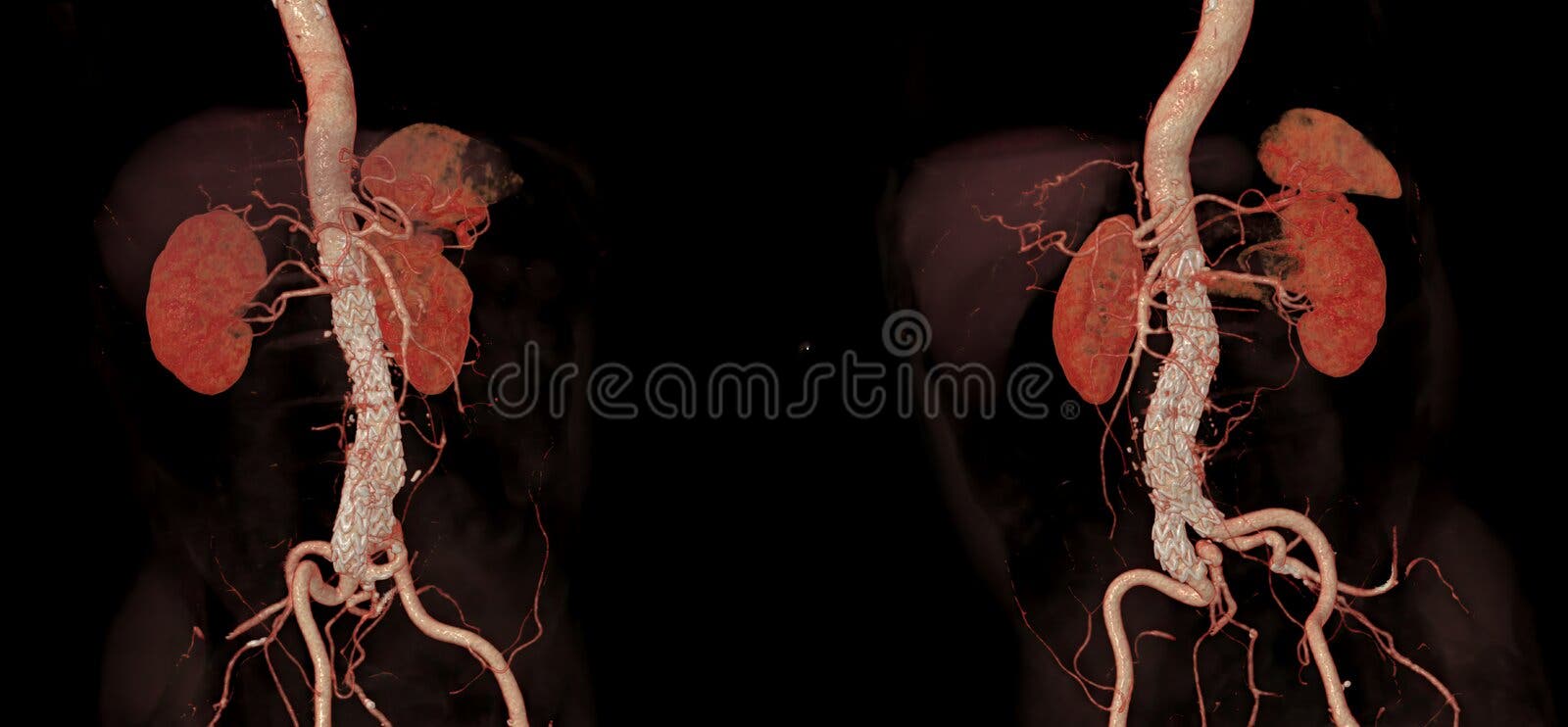 Cta Whole Aorta With Thoracic Aorta Stent Graft 3d Rendering Stock