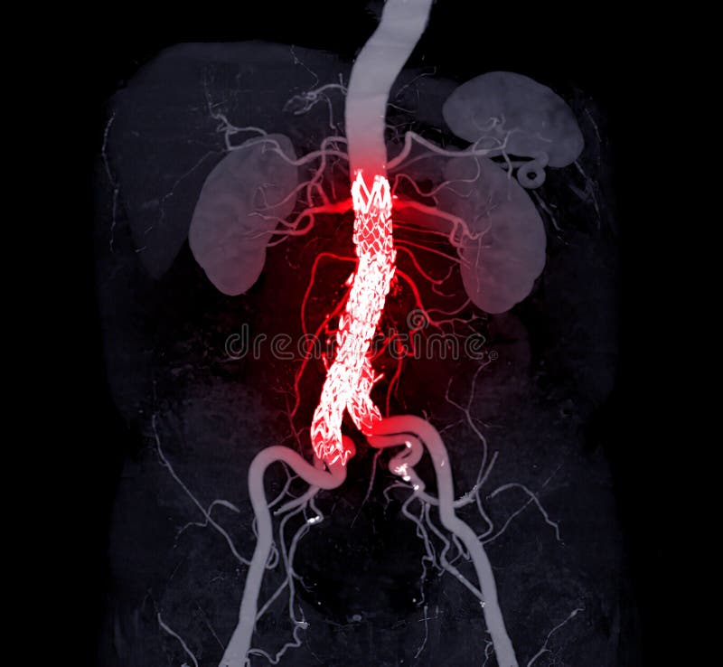 CTA Whole Aorta with Abdominal Aorta Stent Graft Compare 3D Rendering ...