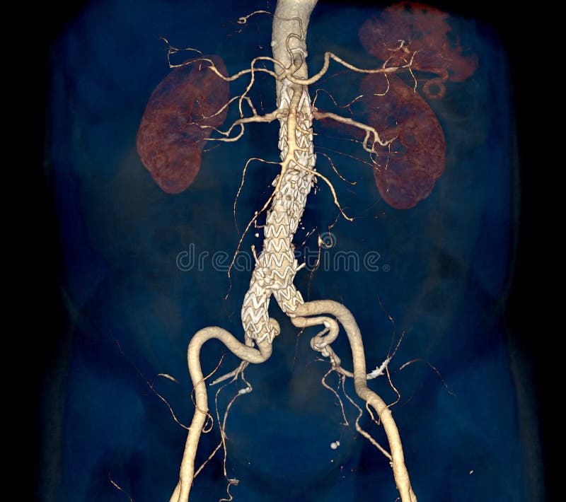 CTA Whole Aorta with Abdominal Aorta Stent Graft Compare 3D Rendering ...