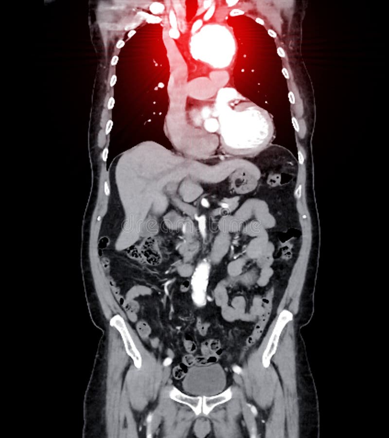 CTA Whole Aorta Imaging Coronal View Displaying an Aortic Aneurysm ...