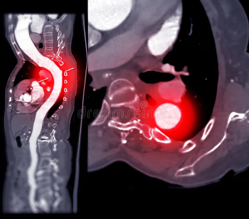 CTA whole aorta MPR Curve stock image. Image of cardiovascular - 281853177