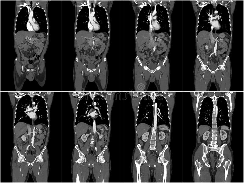 Cuerpo Humano En Exploraciones Del CT Imagen de archivo - Imagen de ...
