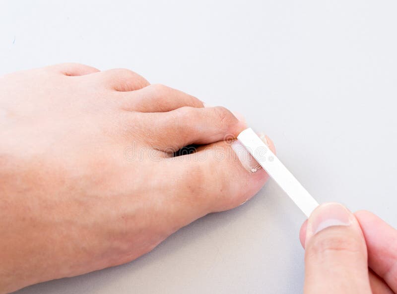 Infección Fungicida Del Clavo Foto de archivo - Imagen de humano ...