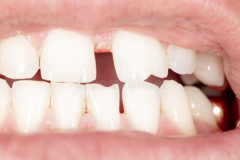 Curved Teeth in a Man`s Mouth Stock Image - Image of dental, teeth ...