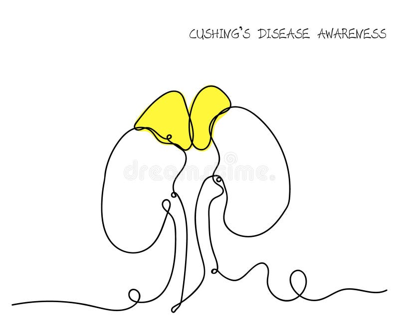 Cushings Disease Stock Illustrations – 76 Cushings Disease Stock ...