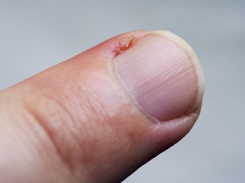Cutícula Inflamada No Dedo. Parte Danificada Do Fecho Do Dedo Imagem de ...