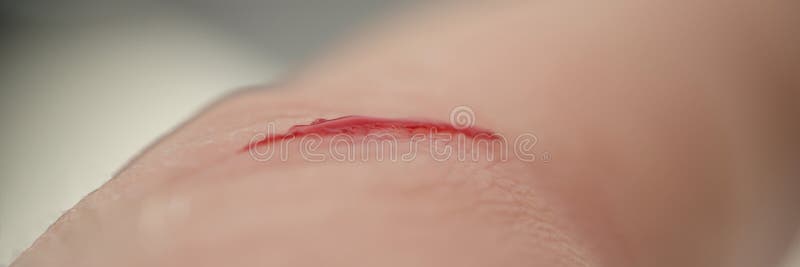 Cut with Blood on the Skin Closeup Stock Image - Image of blood ...