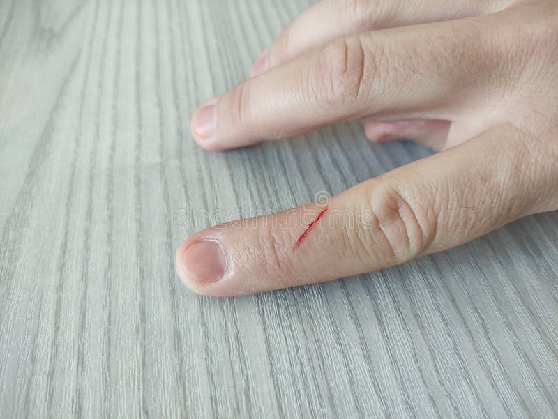 Cut Finger Close Up. Finger Wound. Stock Photo - Image of injury, droplet: 288494342