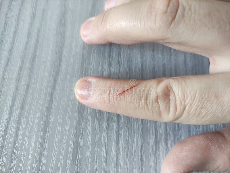 Cut Finger Close Up. Finger Wound. Stock Image - Image of body, finger ...