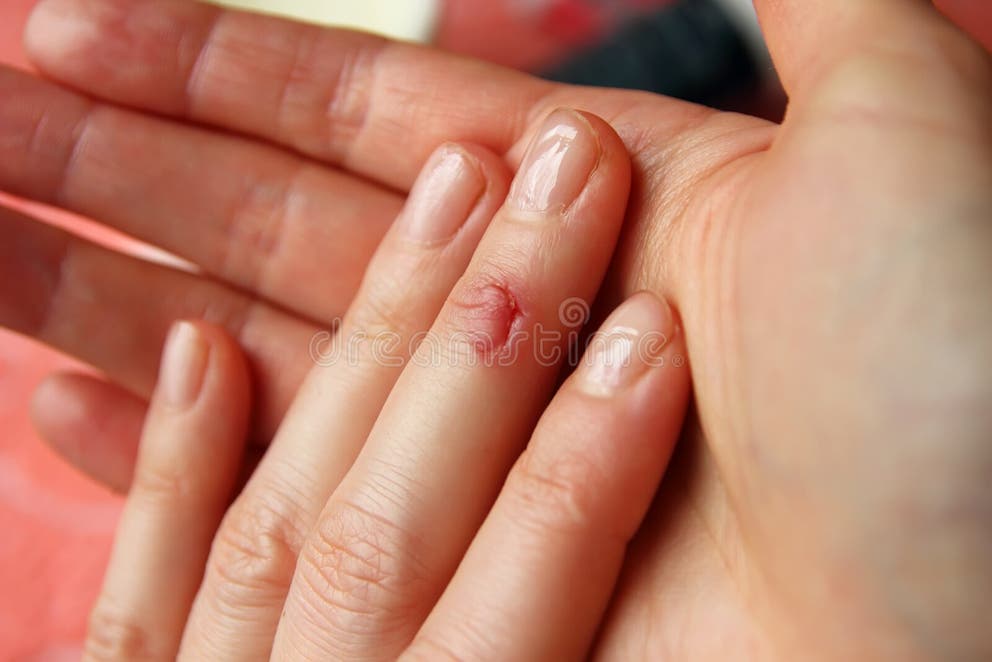 The cut on his finger stock image. Image of medicine - 52467197