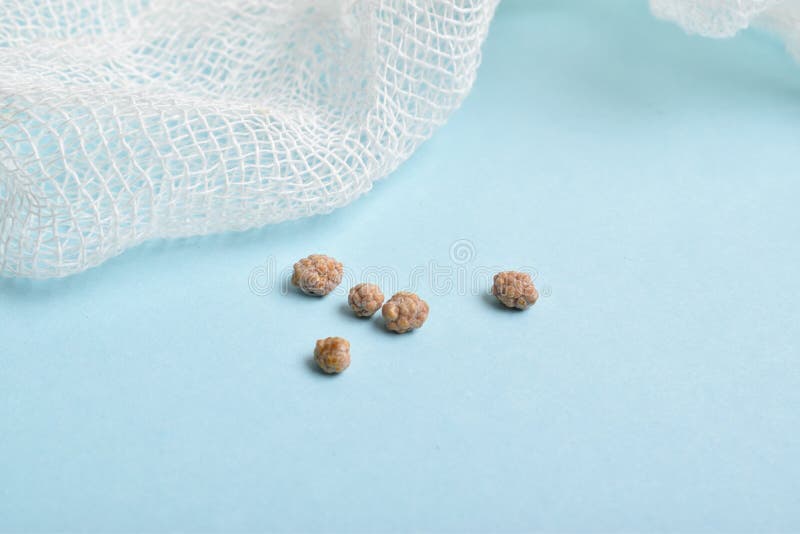 The Cut Stones in the Gallbladder Lie on the Gauze. Laparoscopy Stock ...