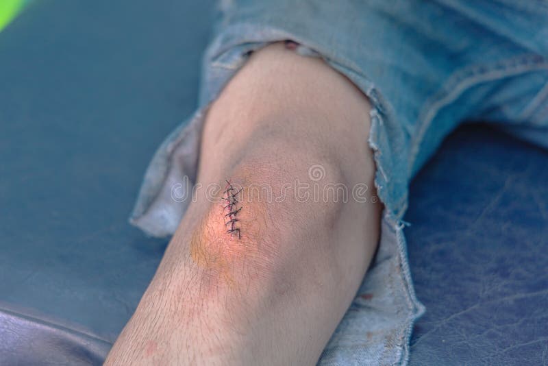 Cut Wound Dressing,cut Wound Surgering Stock Image - Image of injury ...