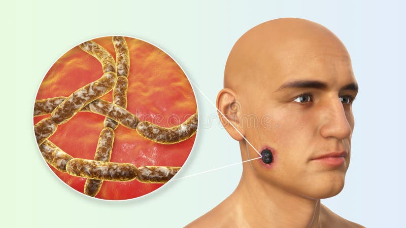 Cutaneous Anthrax, the Most Common Form of Anthrax Stock Illustration ...