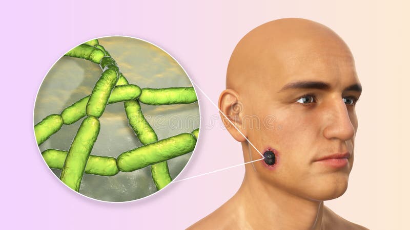 Cutaneous Anthrax, the Most Common Form of Anthrax Stock Illustration ...