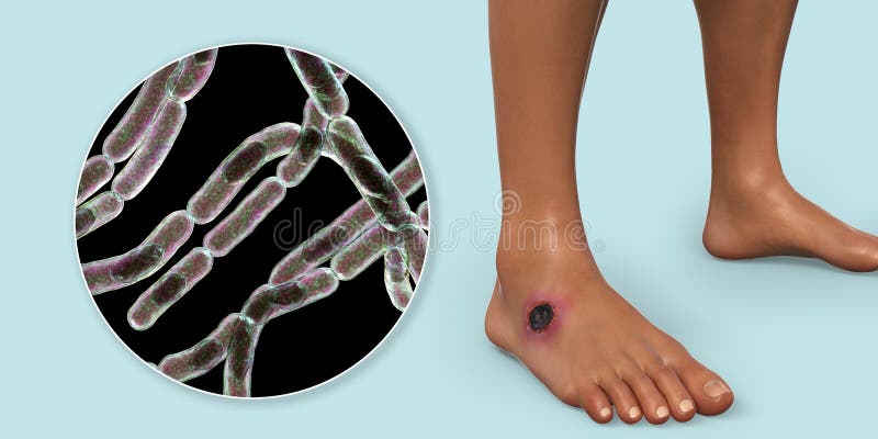 Cutaneous Anthrax, the Most Common Form of Anthrax Stock Illustration ...