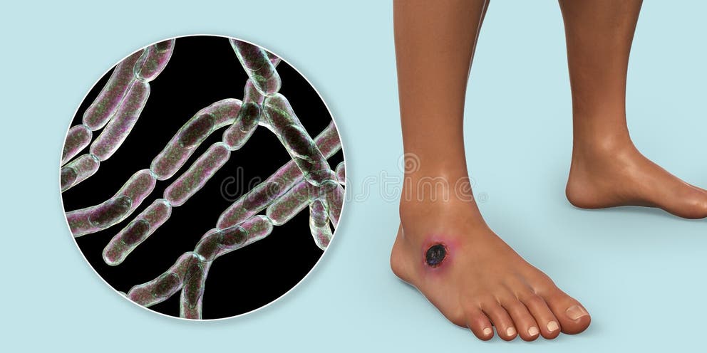 Cutaneous Anthrax, the Most Common Form of Anthrax Stock Illustration ...