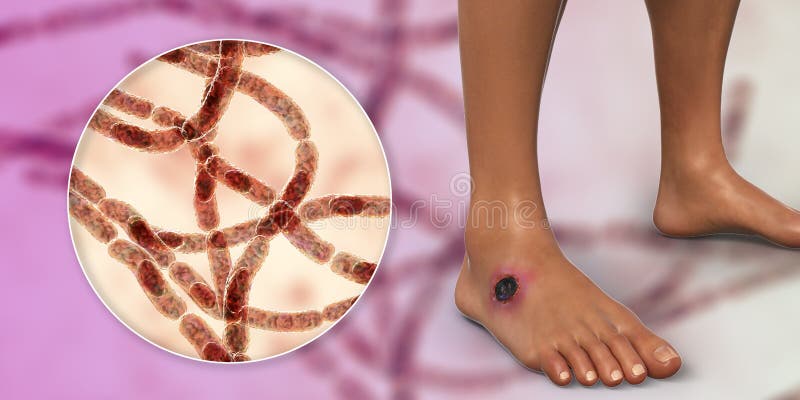 Cutaneous Anthrax, the Most Common Form of Anthrax Stock Illustration ...