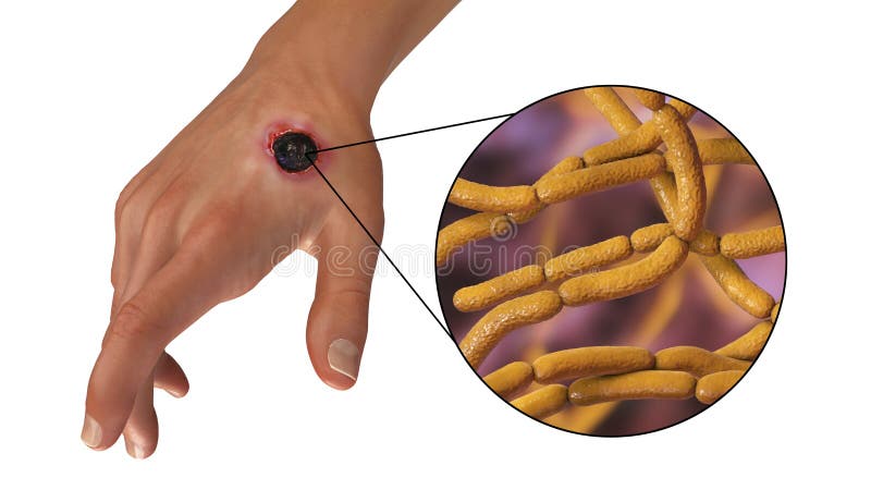 Cutaneous Anthrax, the Most Common Form of Anthrax Stock Illustration ...