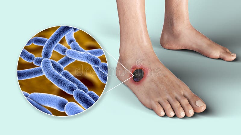 Cutaneous Anthrax, the Most Common Form of Anthrax Stock Illustration ...