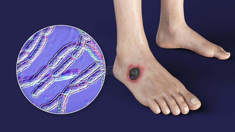Cutaneous Anthrax, the Most Common Form of Anthrax Stock Illustration ...