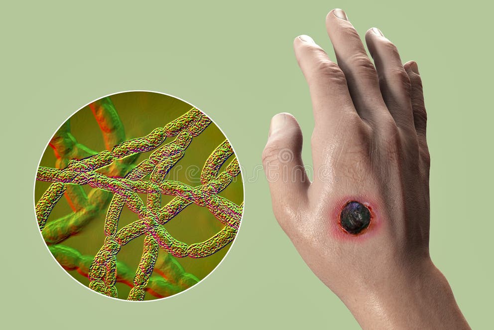 Cutaneous Anthrax, the Most Common Form of Anthrax Stock Illustration ...
