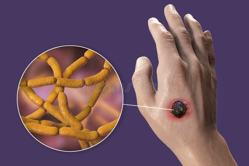 Cutaneous Anthrax, the Most Common Form of Anthrax Stock Illustration ...