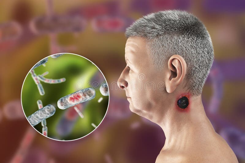 Cutaneous Anthrax, the Most Common Form of Anthrax Stock Illustration ...