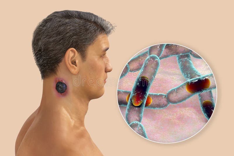 Cutaneous Anthrax, the Most Common Form of Anthrax Stock Illustration ...