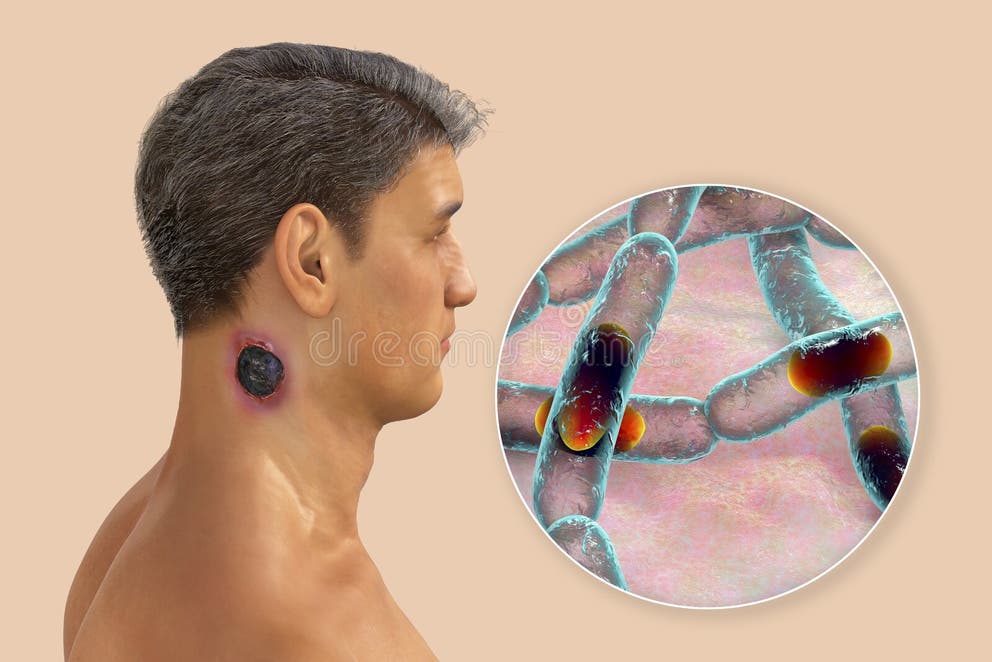 Cutaneous Anthrax, the Most Common Form of Anthrax Stock Illustration ...