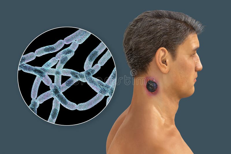 Cutaneous Anthrax, the Most Common Form of Anthrax Stock Illustration ...