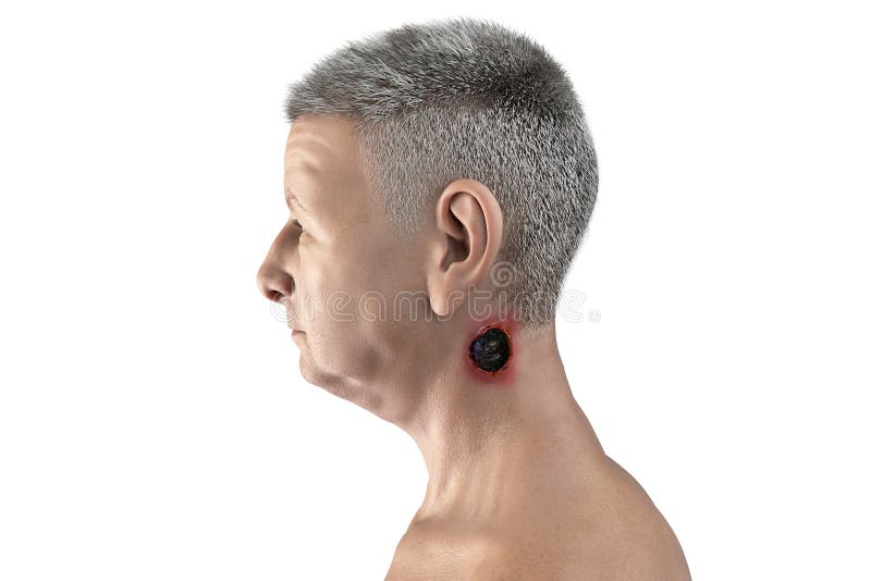 Cutaneous Anthrax, the Most Common Form of Anthrax Stock Illustration ...